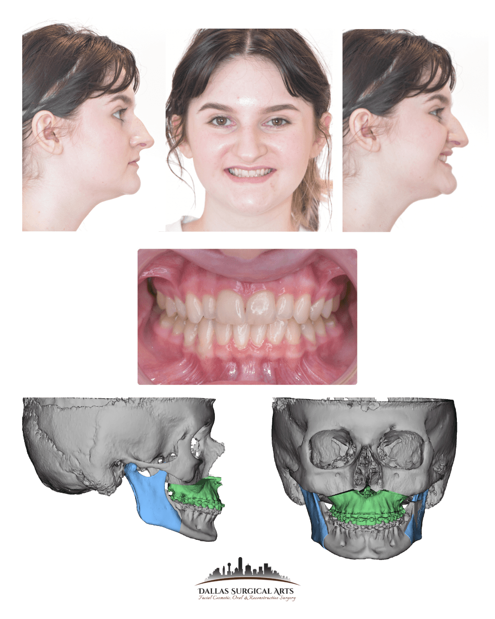 Jaw Repositioning (Orthognathic Surgery) | Dallas Surgical Arts